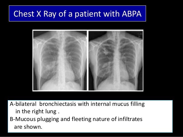 Allergic Broncho Pulmonary Aspergillosis (ABPA) by Dr.Tinku Joseph