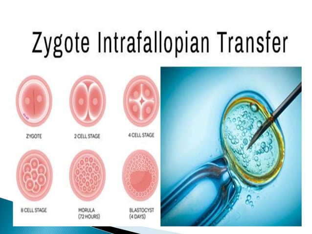 Artificial Reproductive Technology | PPTX | Infertility | Reproductive ...