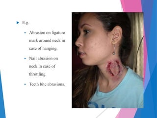 Abrasion | PPTX