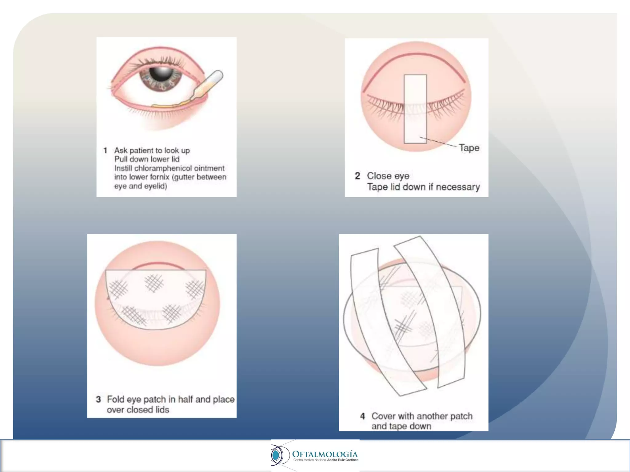 Abrasión corneal y cuerpo extraño corneal 2015 | PPTX | Eye and Vision ...