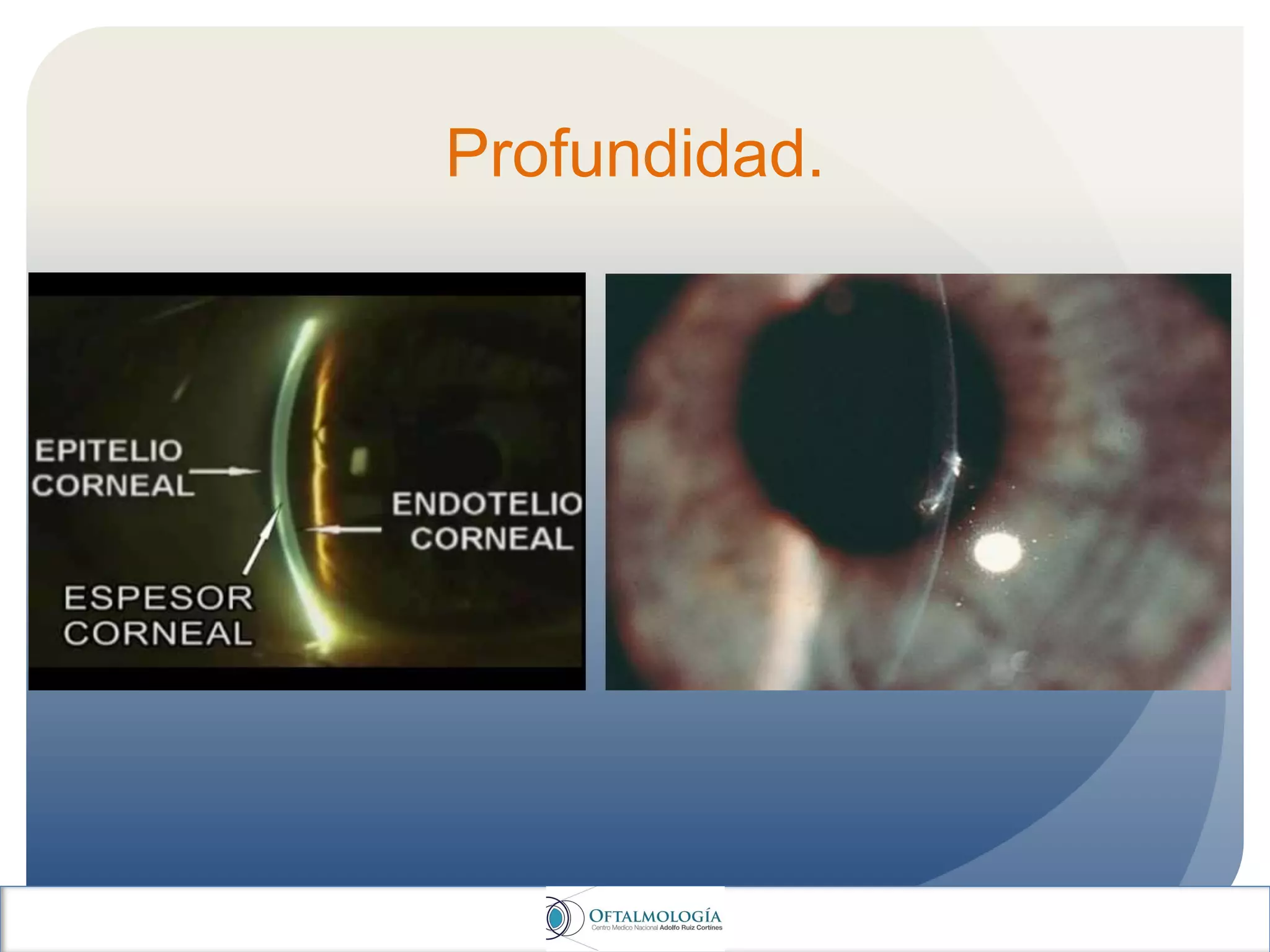 Abrasión corneal y cuerpo extraño corneal 2015 | PPTX | Eye and Vision ...