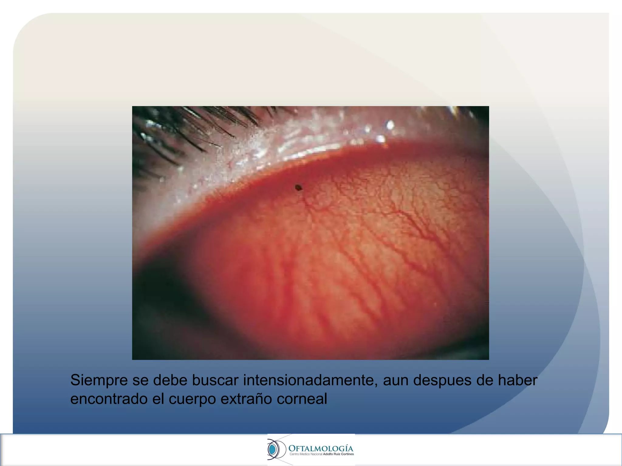 Abrasión corneal y cuerpo extraño corneal 2015 | PPTX | Eye and Vision ...