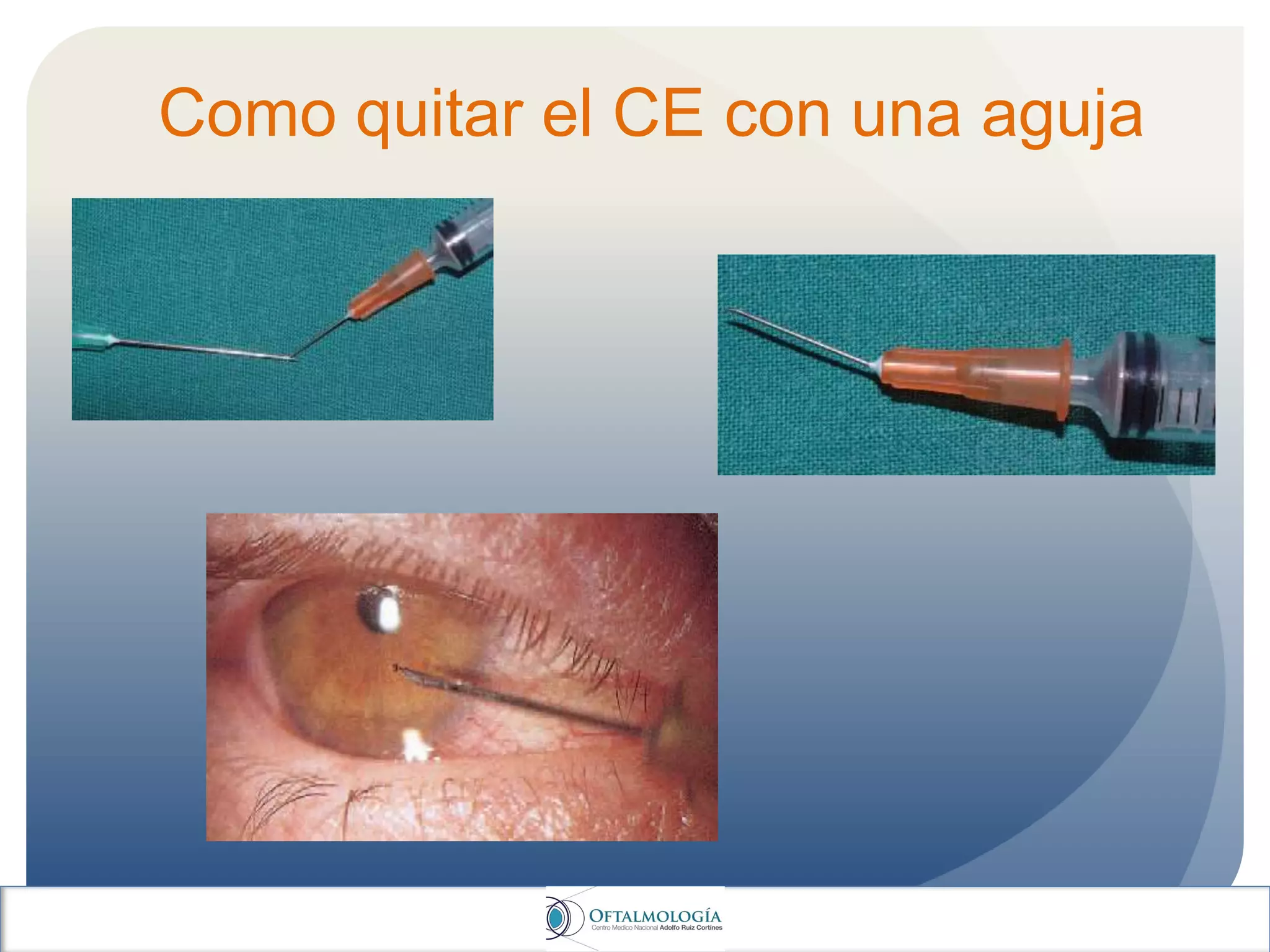 Abrasión corneal y cuerpo extraño corneal 2015 | PPTX | Eye and Vision ...
