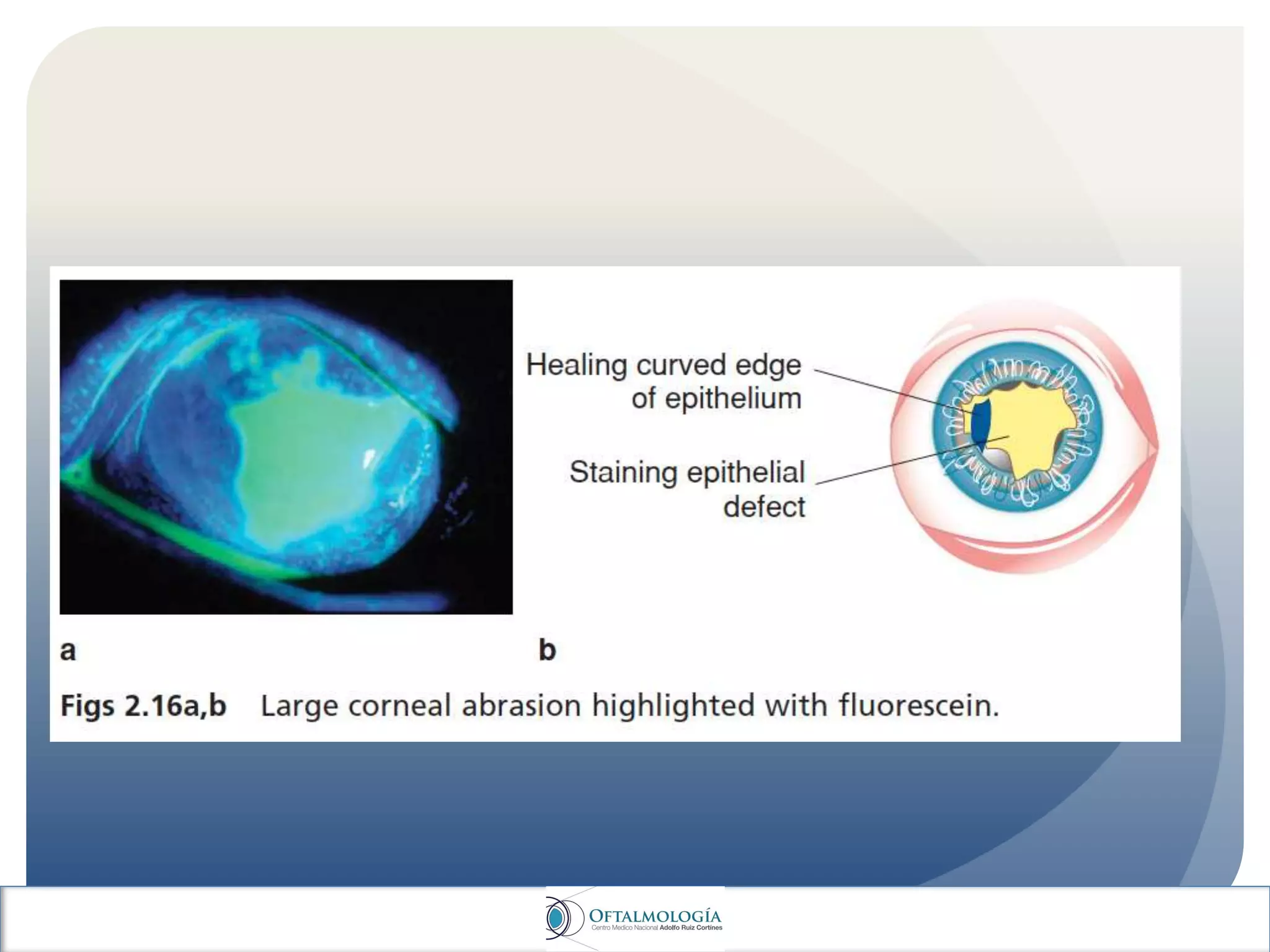 Abrasión corneal y cuerpo extraño corneal 2015 | PPTX | Eye and Vision ...
