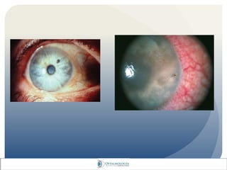 Abrasión corneal y cuerpo extraño corneal 2015 | PPTX | Eye and Vision ...