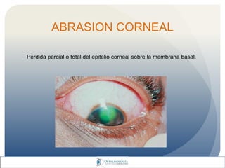 Abrasión corneal y cuerpo extraño corneal 2015 | PPTX | Eye and Vision ...