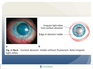Abrasión corneal y cuerpo extraño corneal 2015 | PPTX | Eye and Vision ...