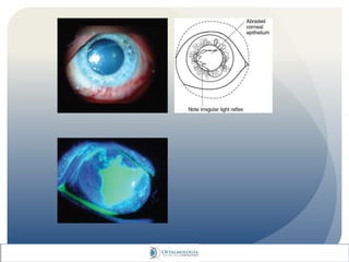 Abrasión corneal y cuerpo extraño corneal 2015 | PPTX | Eye and Vision ...