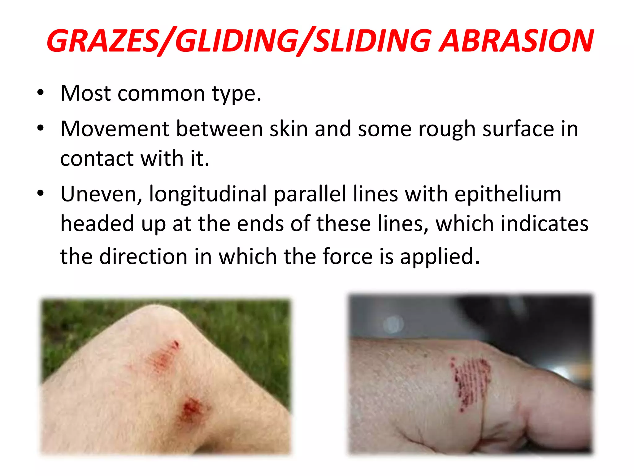 Abrasions | PPTX