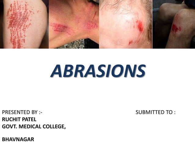 Abrasions | PPTX