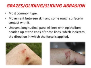 Abrasion Definition