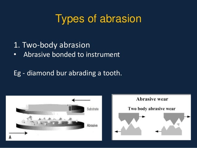 Abrasive agents in dentistry