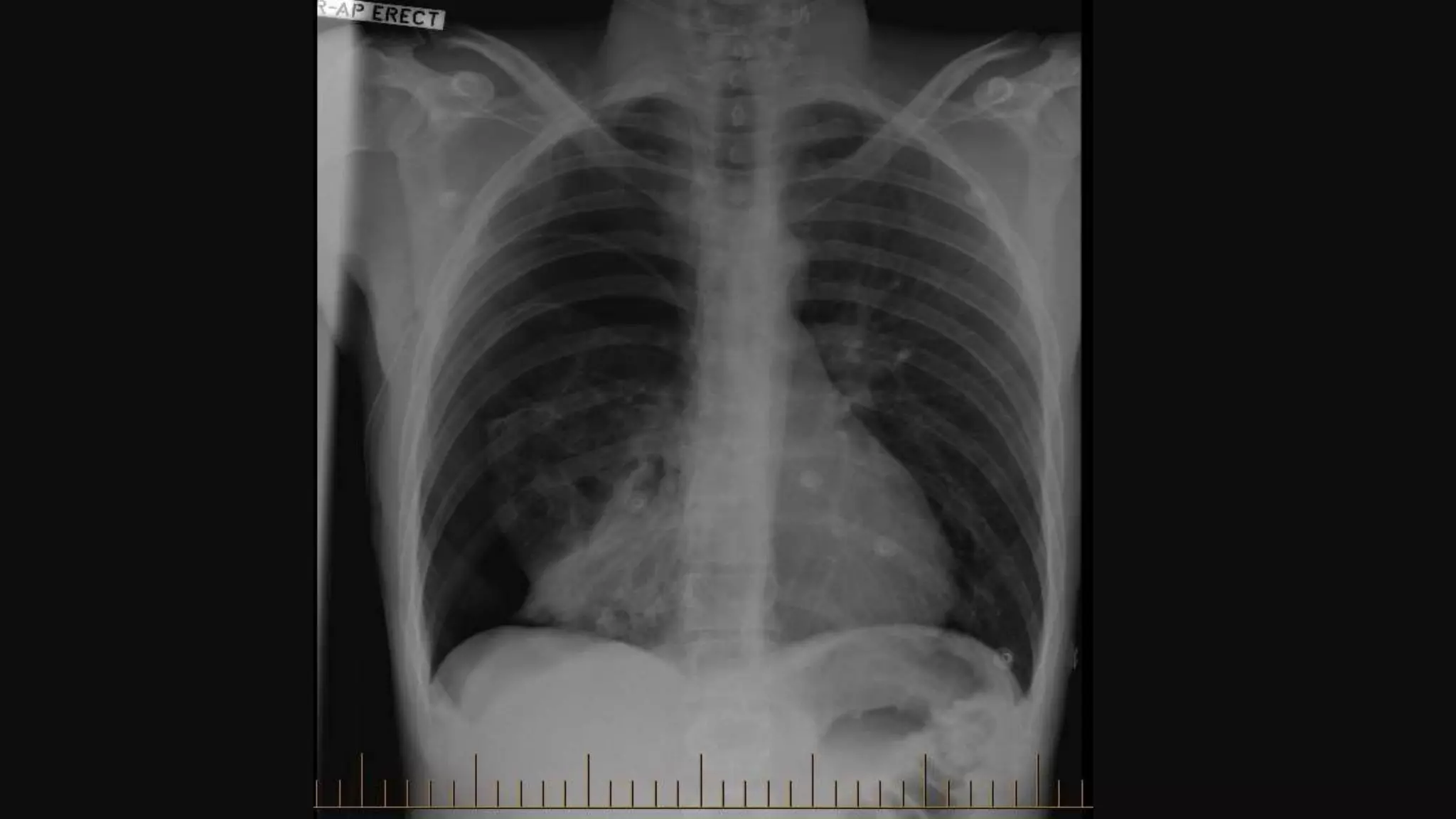 A breathless patient | PPTX
