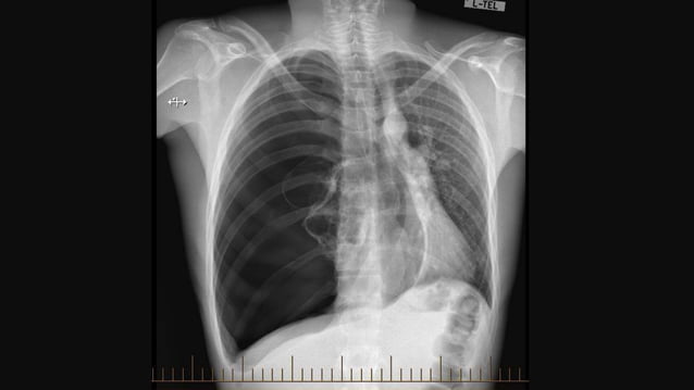 A breathless patient | PPTX