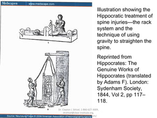 A Brief History of Scoliosis Treatment | PPT