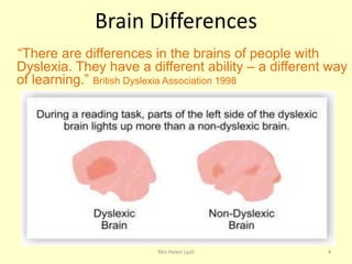 A brief look at dyslexia | PPTX