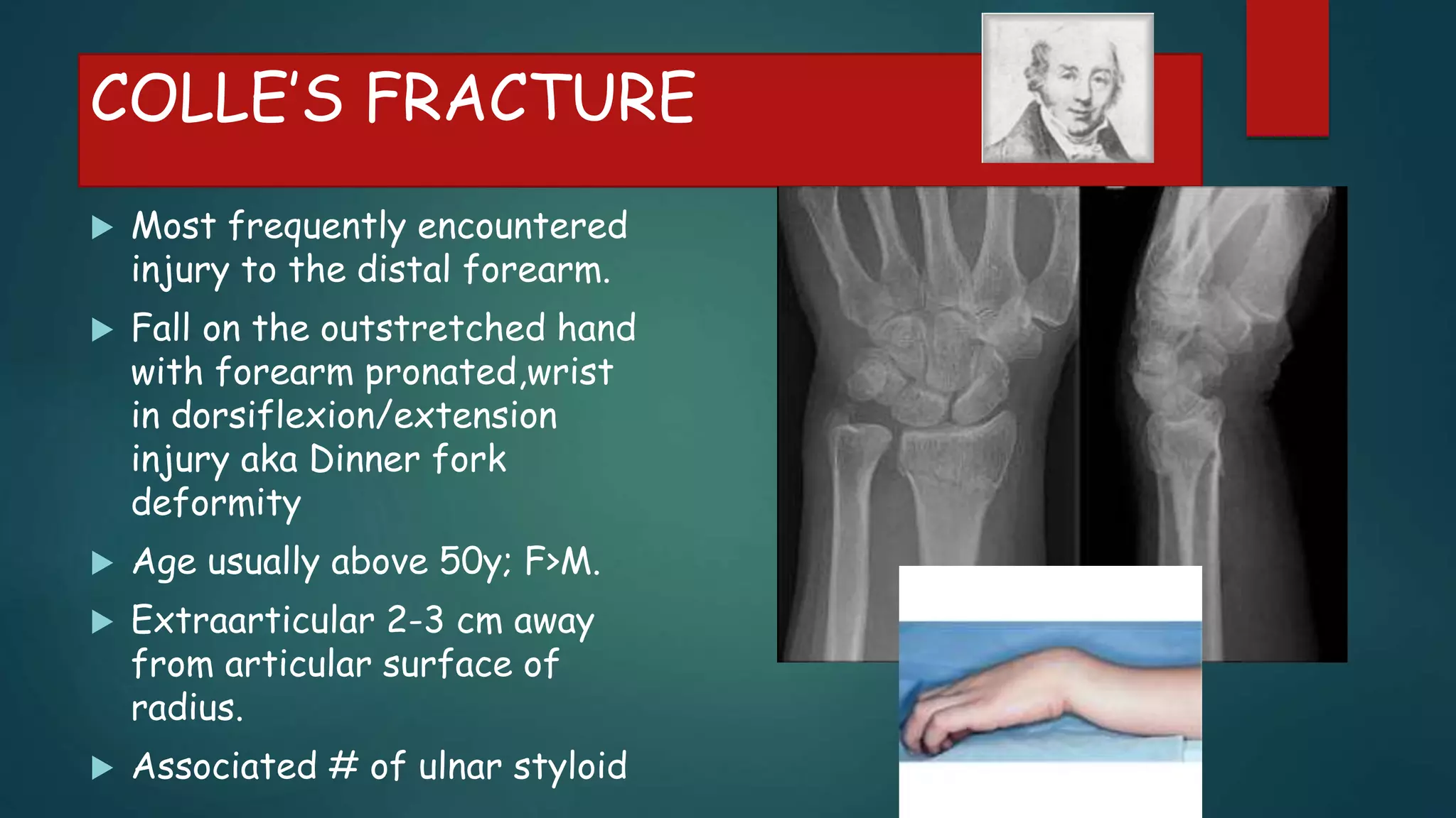 A brief review of distal radius fractures | PPTX