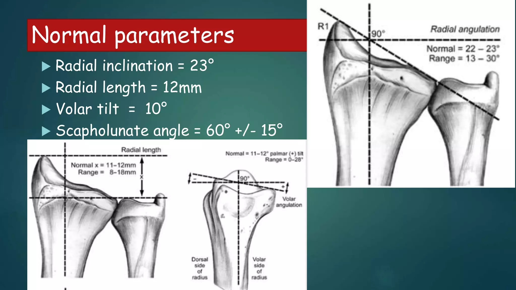 A brief review of distal radius fractures | PPTX