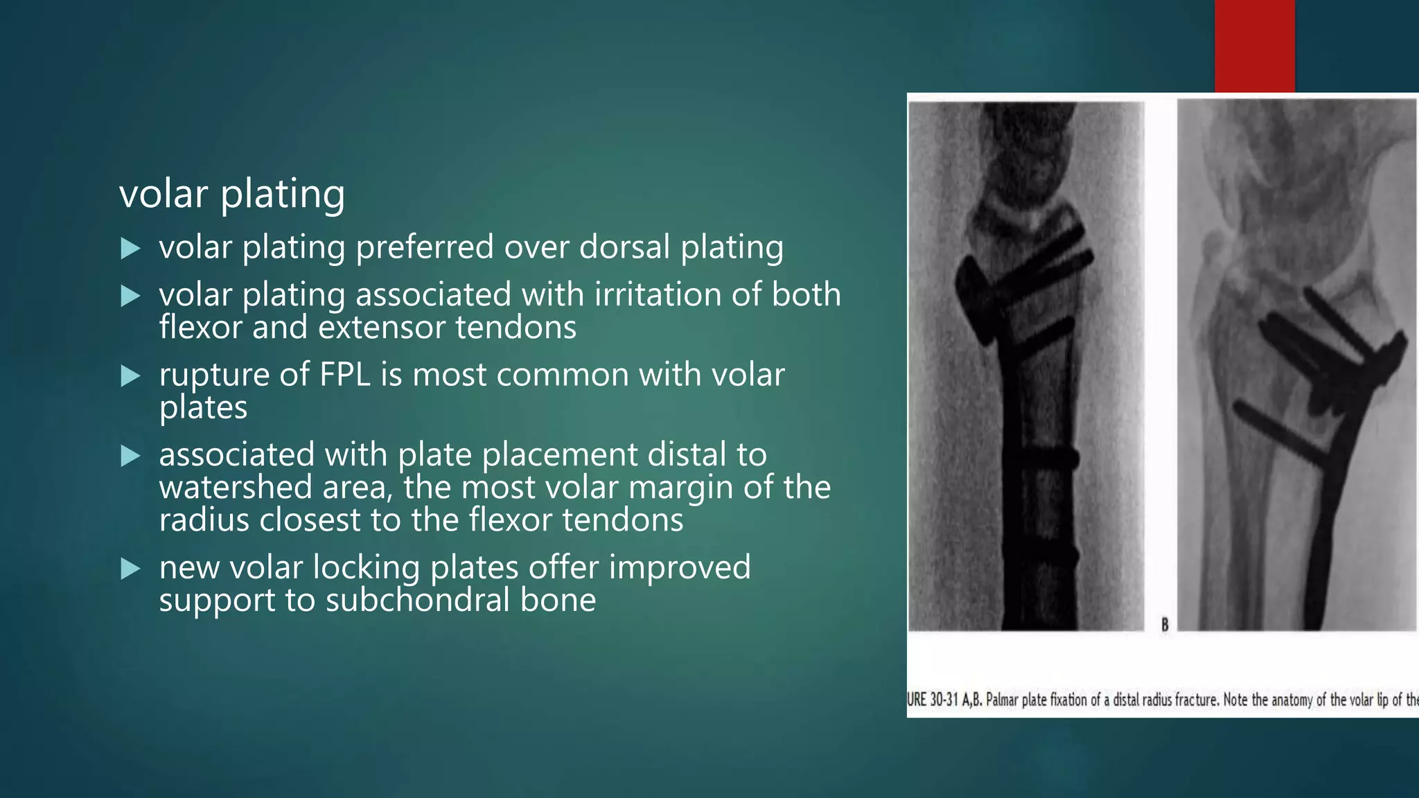 A brief review of distal radius fractures | PPTX