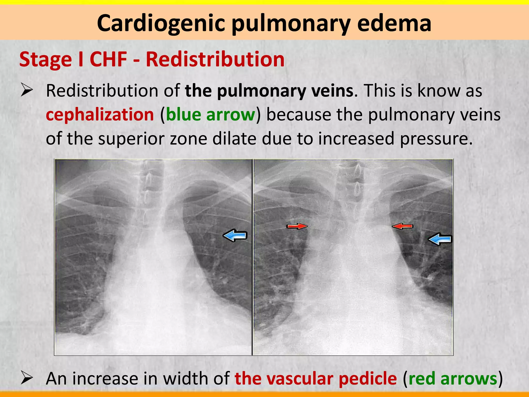 A brief synopsis of acute decompensated heart failure | PDF