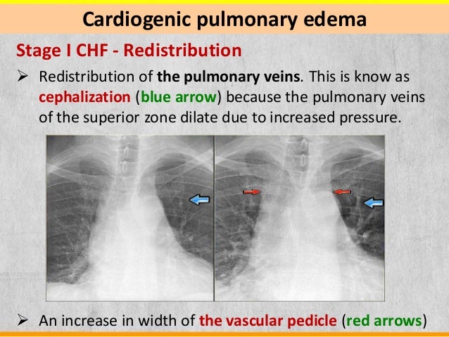 A brief synopsis of acute decompensated heart failure