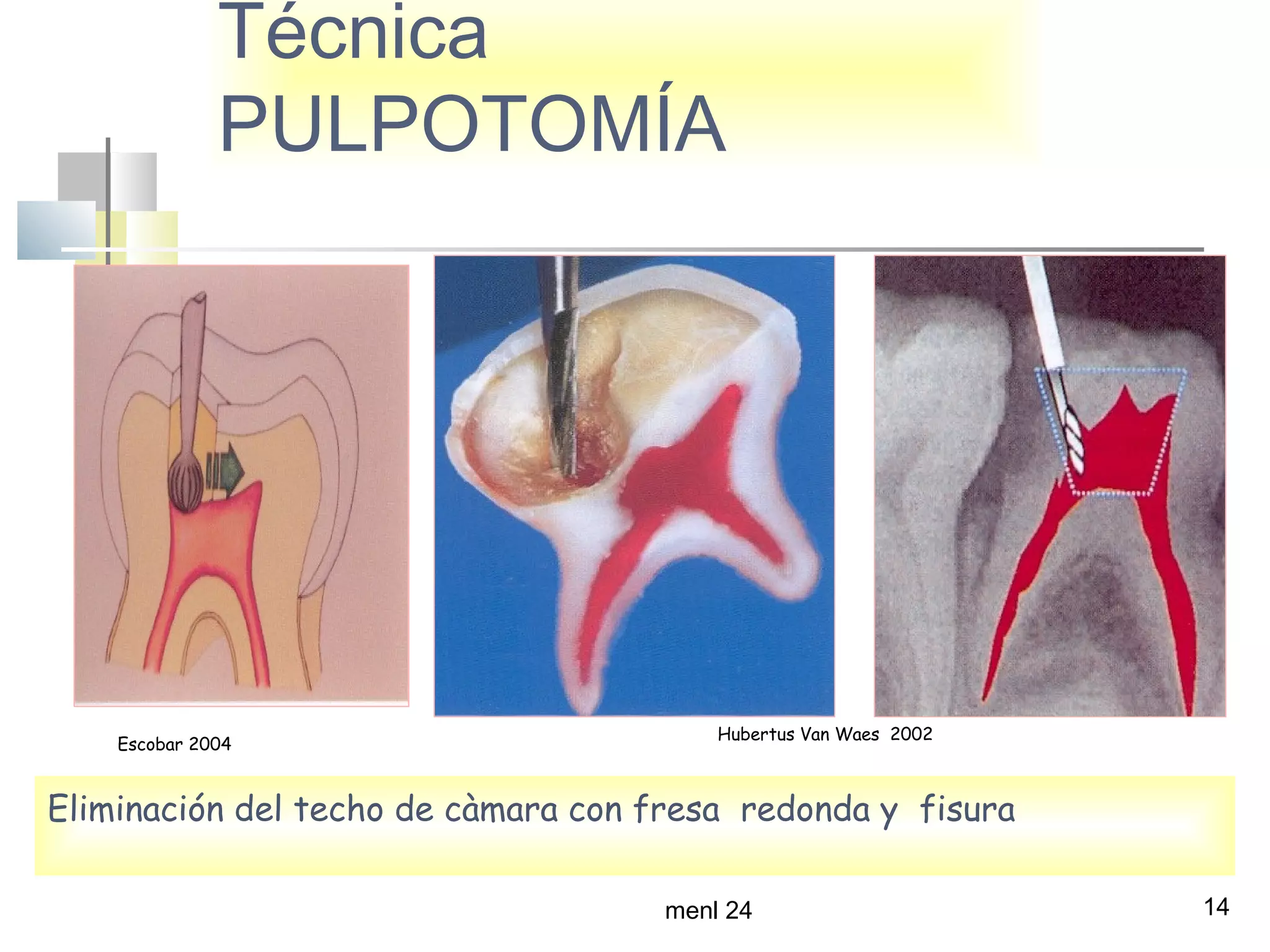 Abril Endodoncia en la Dentición Decidua | PPT | Dental Health ...
