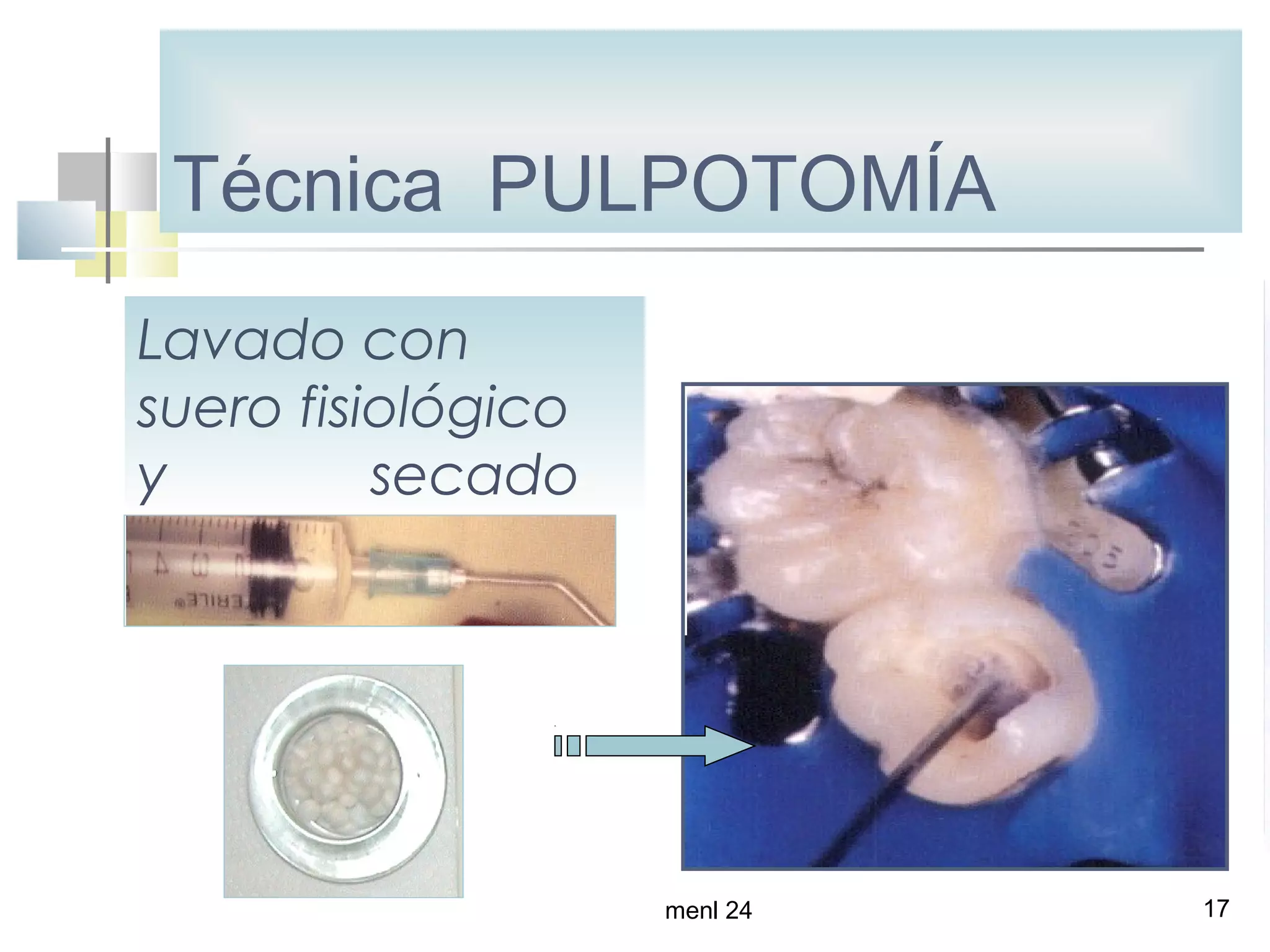 Abril Endodoncia en la Dentición Decidua | PPT | Dental Health ...