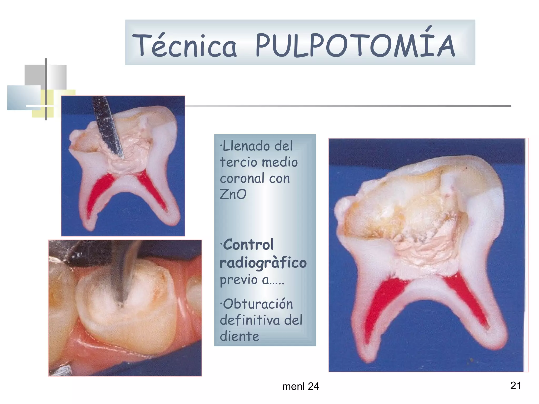 Abril Endodoncia en la Dentición Decidua | PPT | Dental Health ...