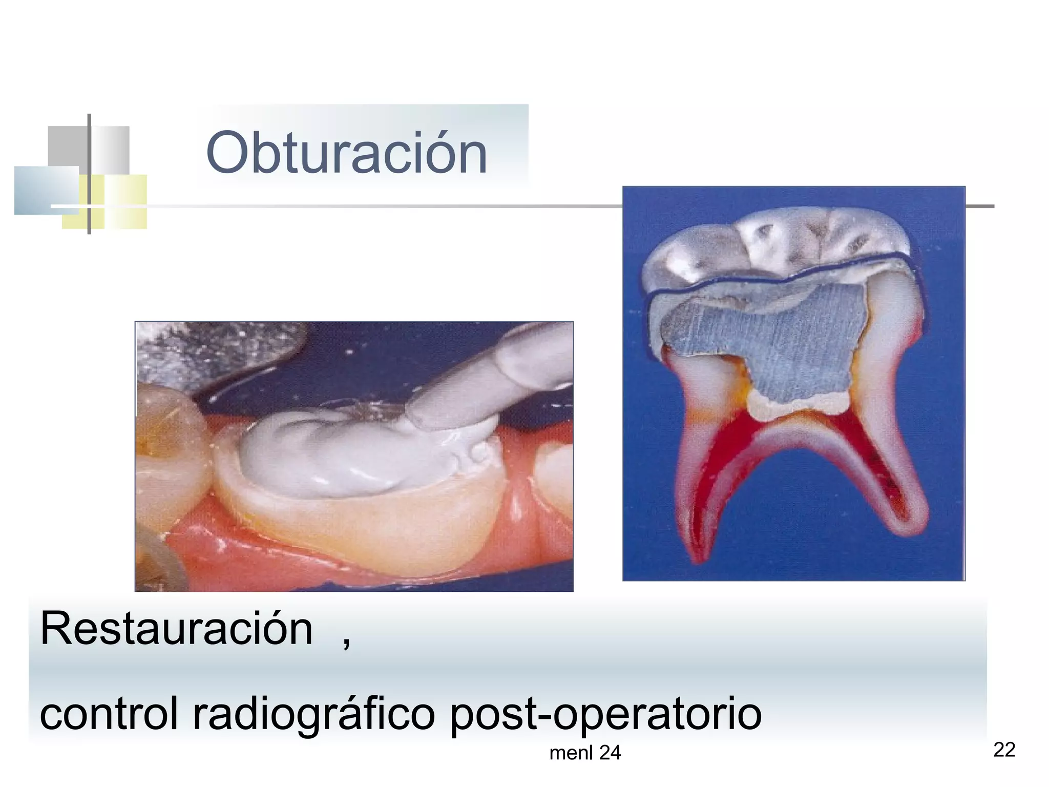Abril Endodoncia en la Dentición Decidua | PPT | Dental Health ...