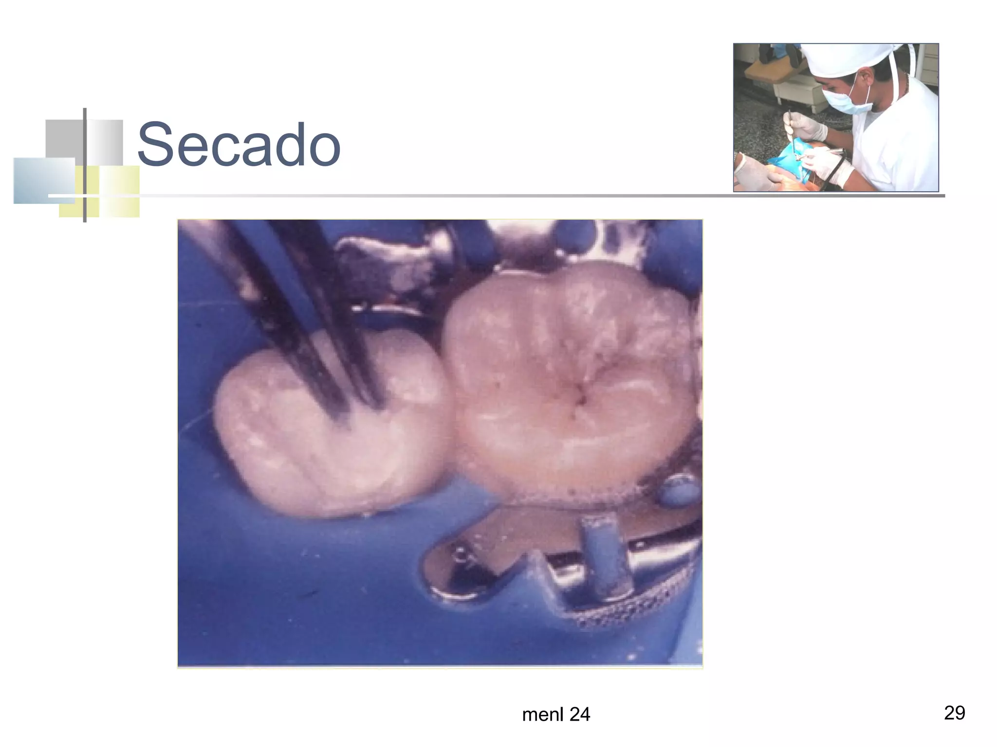 Abril Endodoncia en la Dentición Decidua | PPT | Dental Health ...