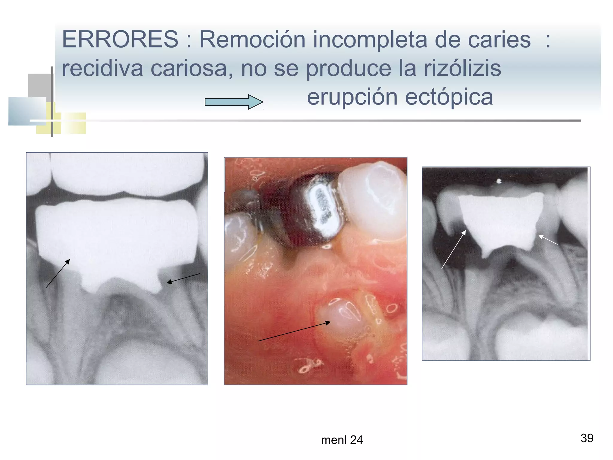 Abril Endodoncia en la Dentición Decidua | PPT | Dental Health ...