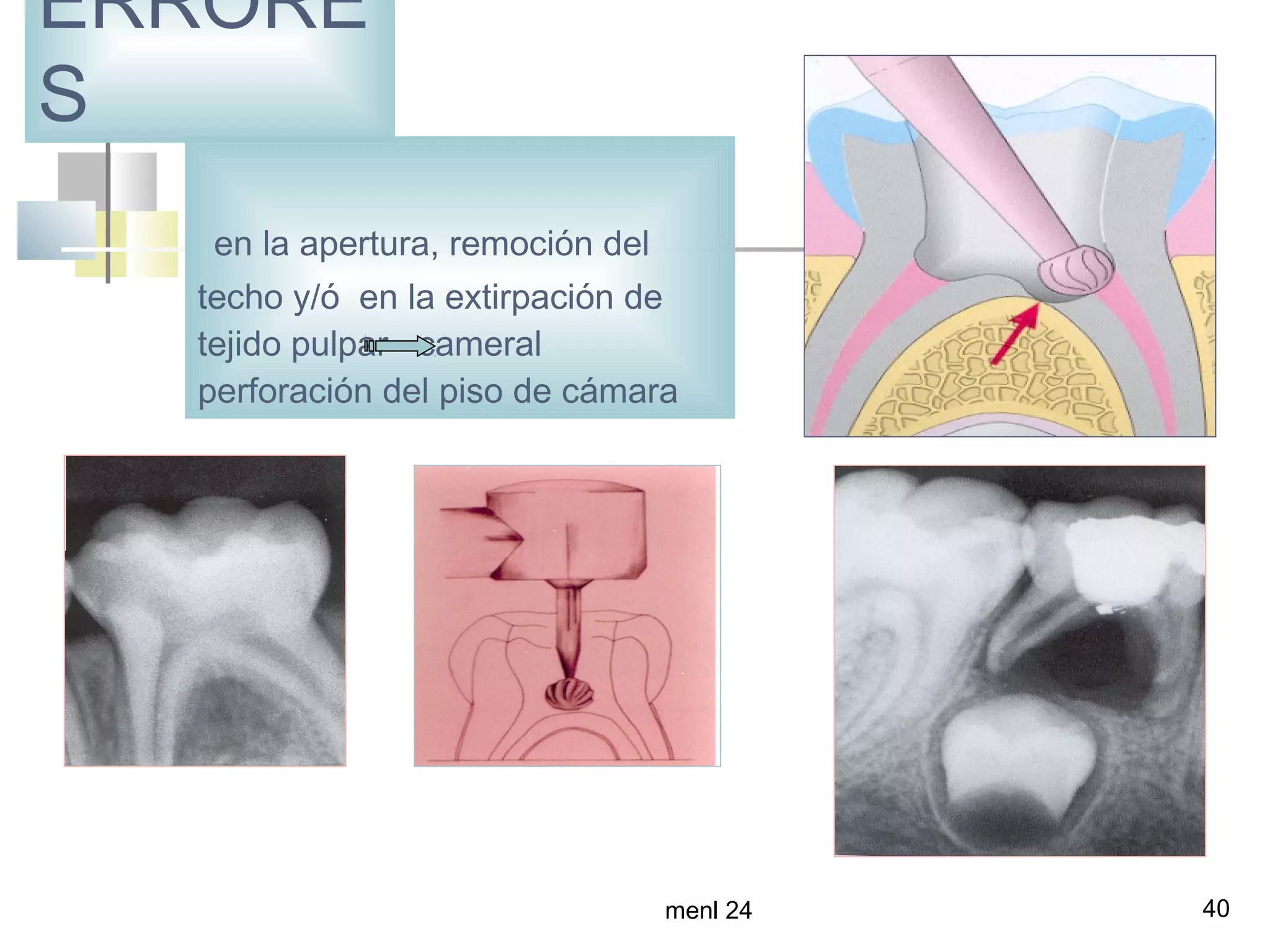 Abril Endodoncia en la Dentición Decidua | PPT | Dental Health ...