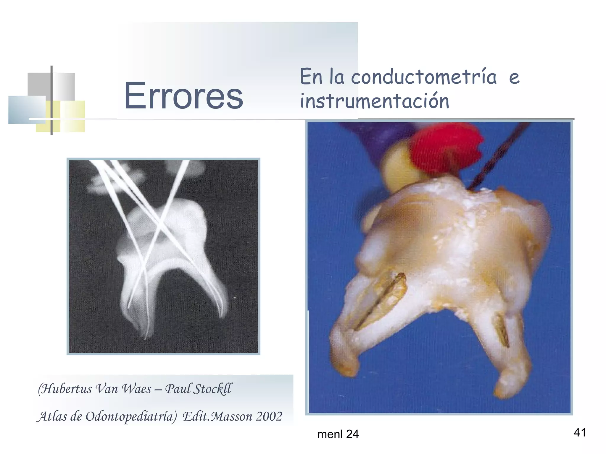 Abril Endodoncia en la Dentición Decidua | PPT | Dental Health ...