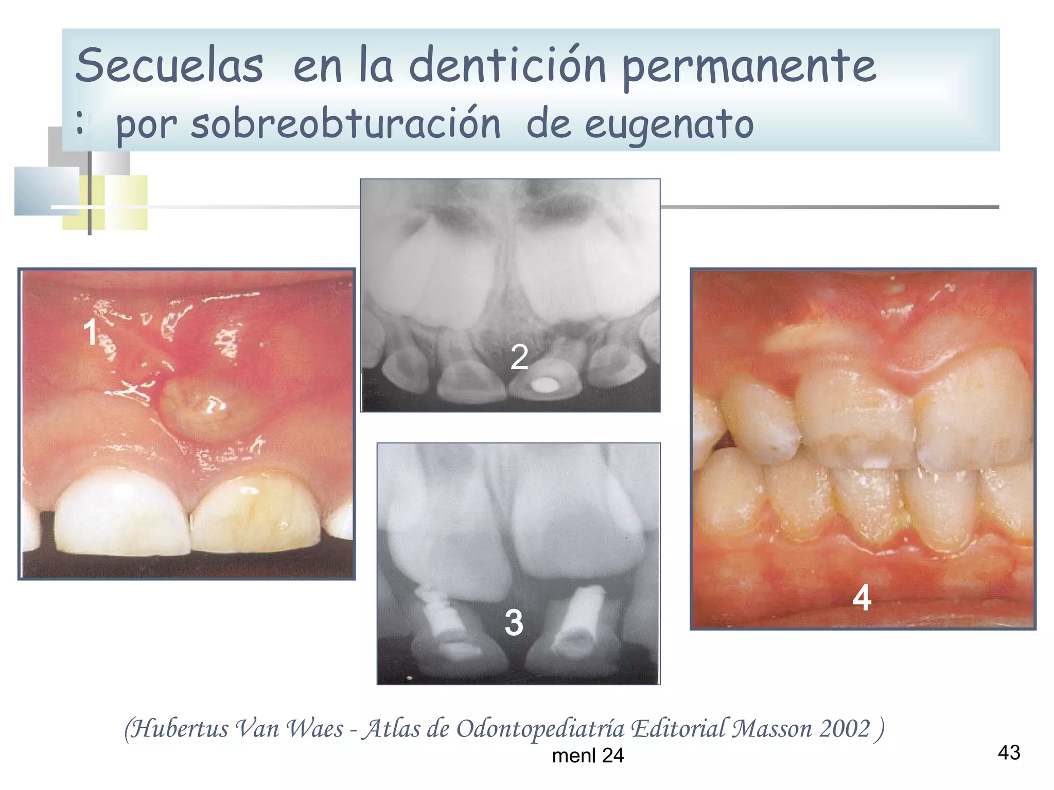 Abril Endodoncia en la Dentición Decidua | PPT | Dental Health ...