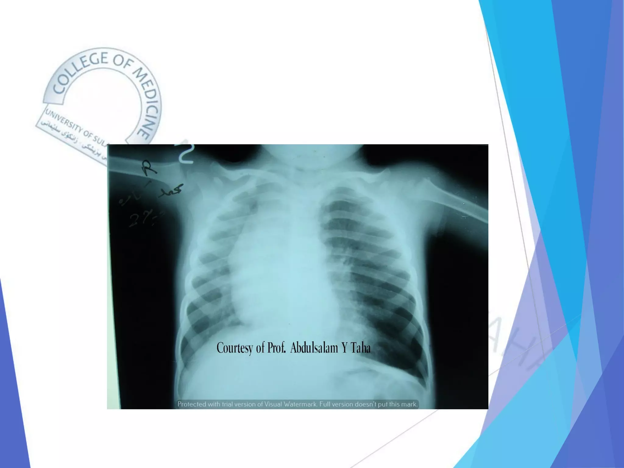 A Bronchial Foreign Body with Obstructive Emphysema.pdf