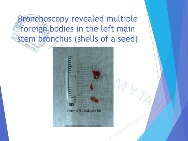 A Bronchial Foreign Body with Obstructive Emphysema.pdf