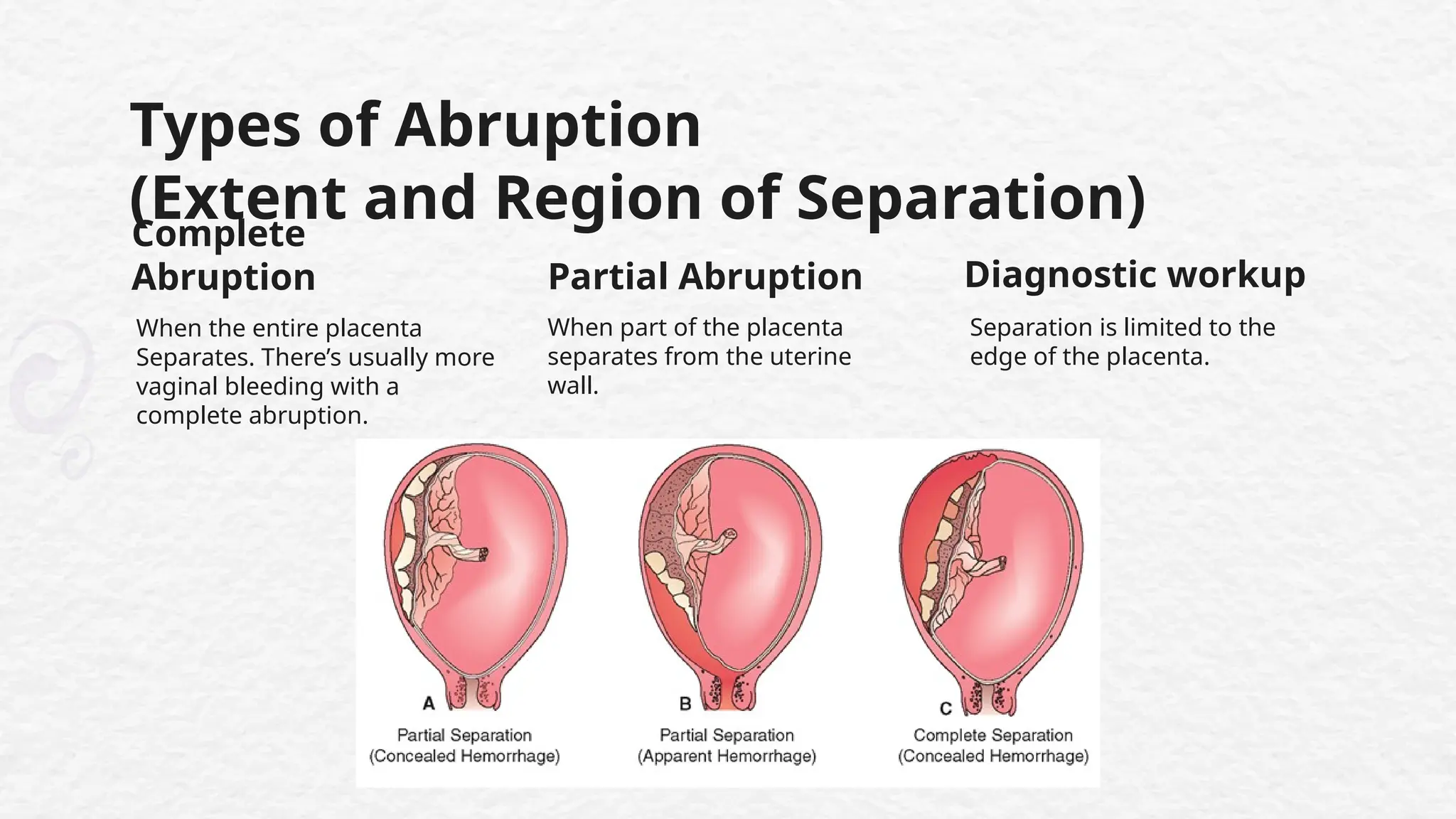 Abruptio-Placentajdjdjdjjdjdjdjdjjdjd.pptx
