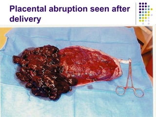 Abruptio Placenta | PPT
