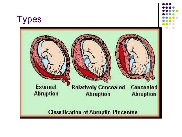 Abruptio Placenta