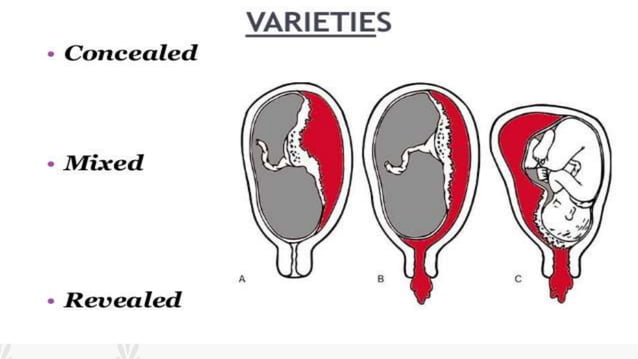 Abruptio placenta including nursing management. | PPT