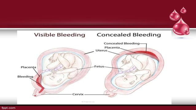 Placental Abruption (Accidental hemorrhage) | PPT