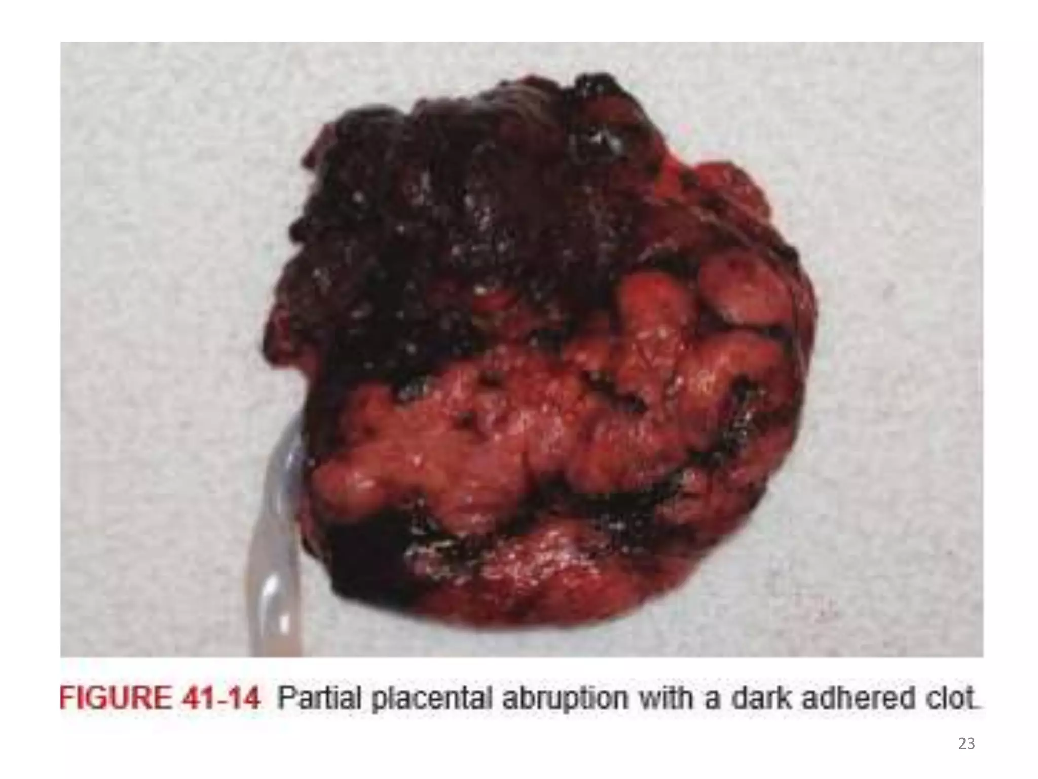 Abruptio placenta | PPTX