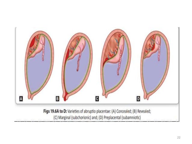 Abruptio placenta | PPT