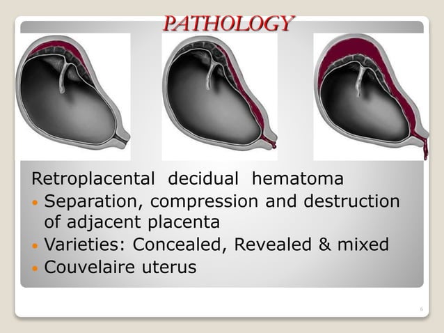 Abruptio placenta- Define, cause, sign and symptoms, Risk Factors ...