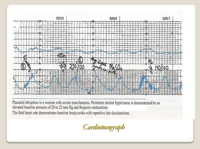 Abruptio placenta- Define, cause, sign and symptoms, Risk Factors ...
