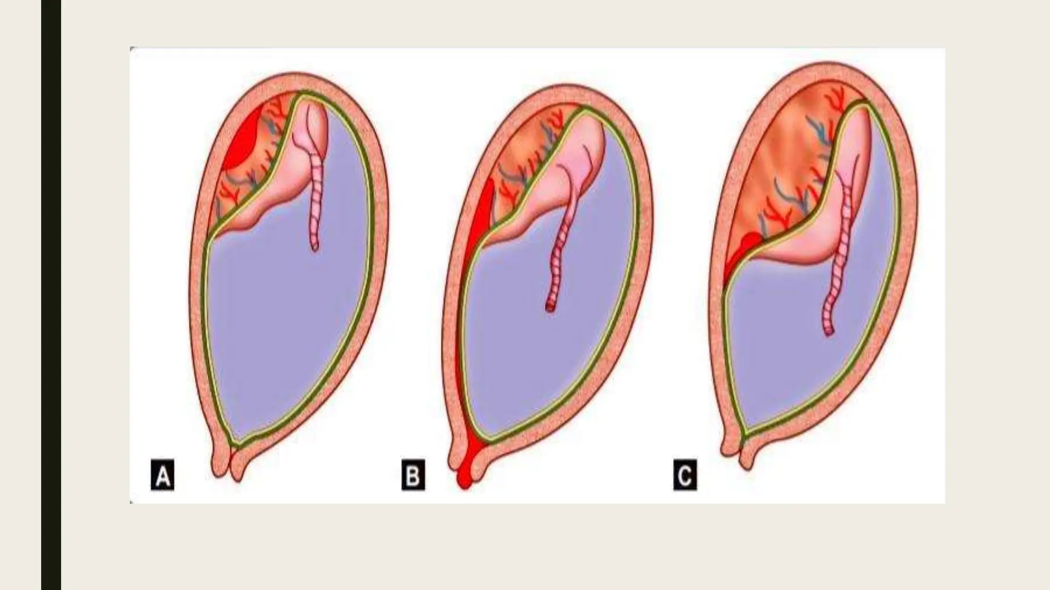 Antepartum Haemorrhage: Abruptio Placenta | PPT