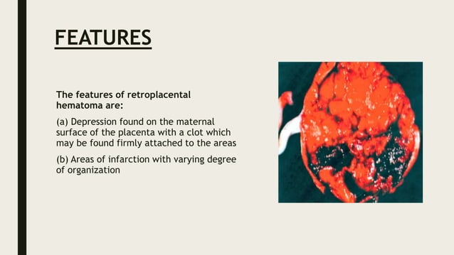 Antepartum Haemorrhage: Abruptio Placenta | PPT