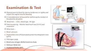 abruptio placenta , ante partum hemorrhage | PPT