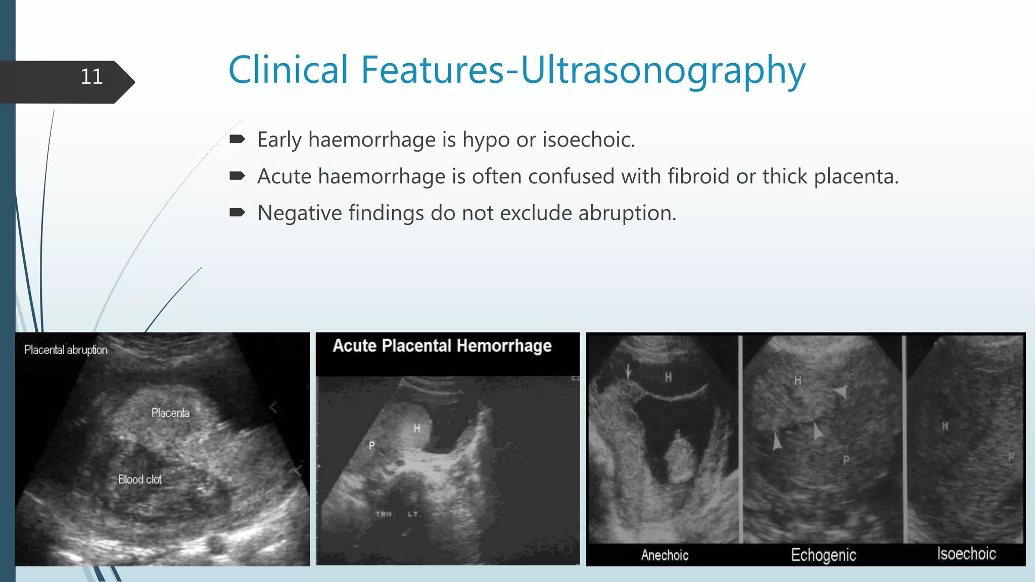 Abruptio placenta clinical features | PPTX