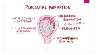 Abruptio placentae | PPT